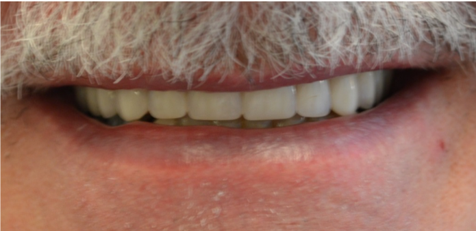 Hybrid Restoration Gallery - Icon Dental
