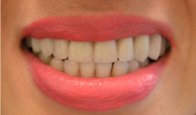 Hybrid Restoration Gallery - Icon Dental