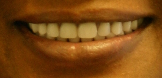 Hybrid Restoration Gallery - Icon Dental