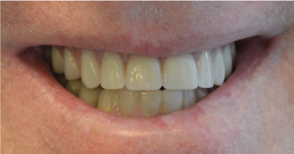 Hybrid Restoration Gallery - Icon Dental