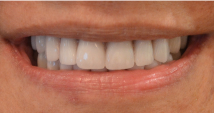 Hybrid Restoration Gallery - Icon Dental