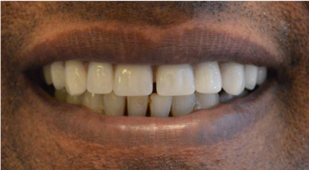 Hybrid Restoration Gallery - Icon Dental