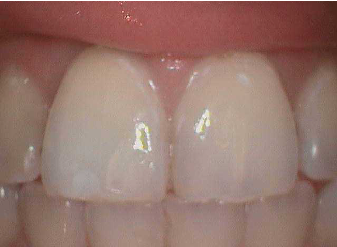 Internal Whitening Gallery - Icon Dental