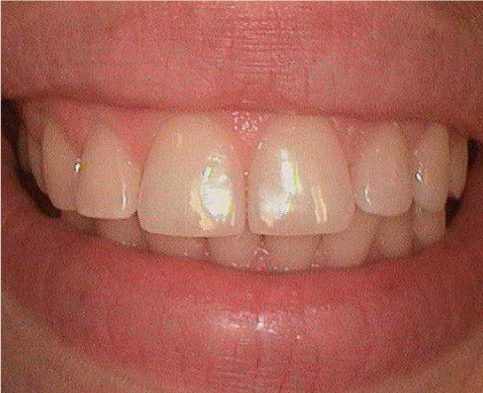 Internal Whitening Gallery - Icon Dental