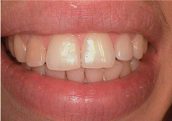 Internal Whitening Gallery - Icon Dental