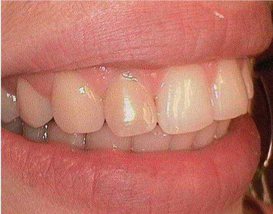 Internal Whitening Gallery - Icon Dental