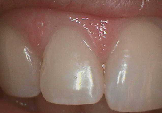 Internal Whitening Gallery - Icon Dental