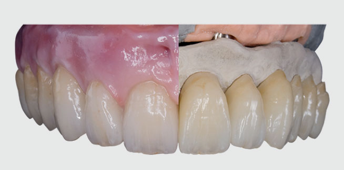 Pekkton Full Arch Restorations - Icon Dental